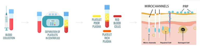 PRP and Microneedling Fort Lauderdale - Aesthetix Dermatology of Ft ...